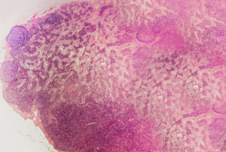 O que é o Melanoma Lentiginoso Acral? O que é o Melanoma Lentigo Maligno?